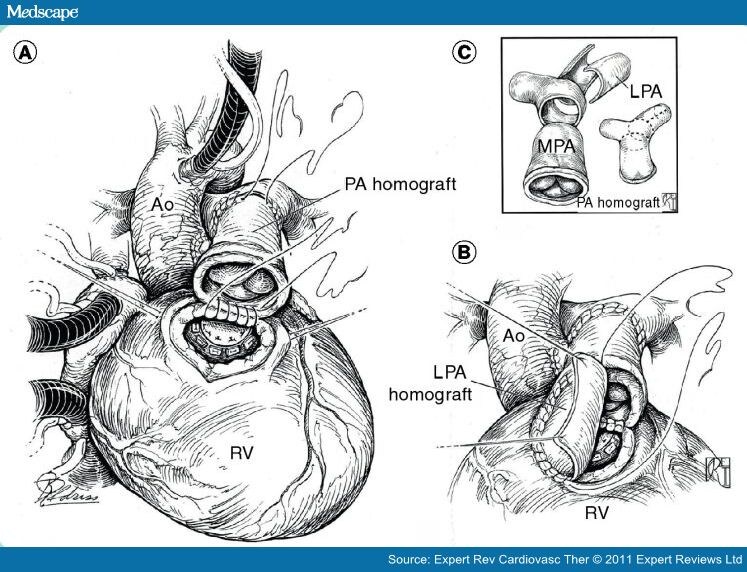 Common Arterial Trunk - Page 5