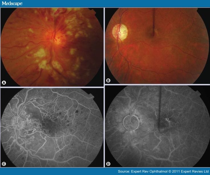 Anti-VEGF Therapy in Macular Edema Secondary to CRVO - Page 7