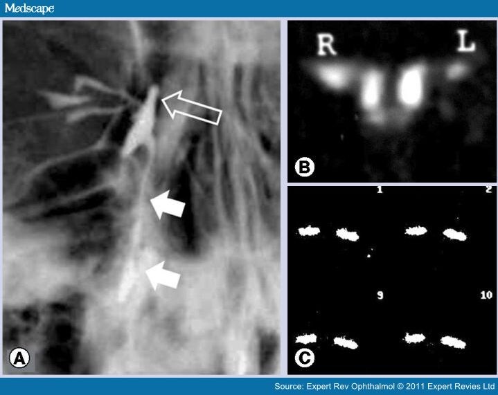 Functional Nasolacrimal Duct Obstruction - Page 3