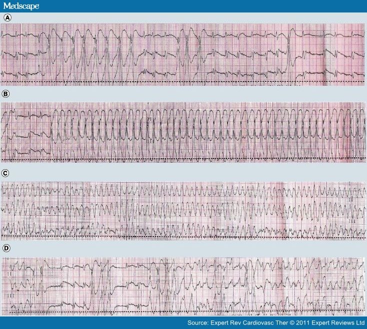 ECG Findings Associated With Cocaine Use in Humans - Page 4