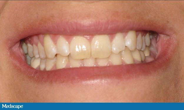 Beyond Wires and Brackets: A Modern Tooth Movement - Page 4