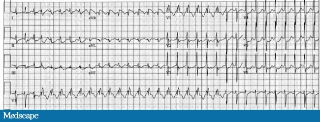 Why Does the QRS Morphology Change?