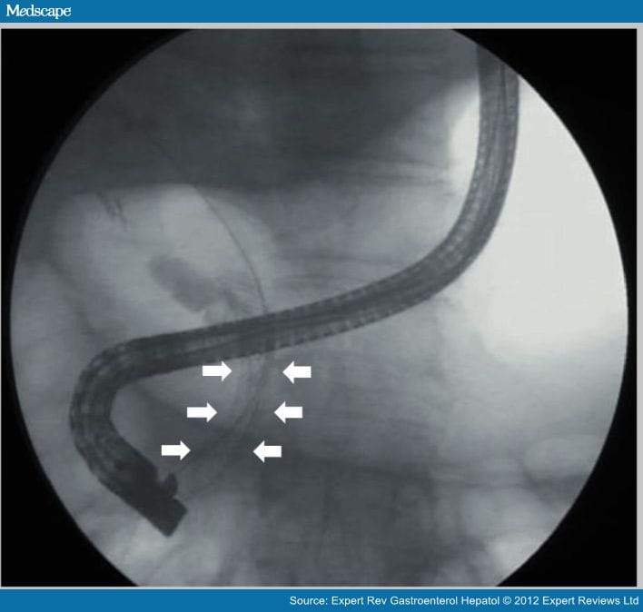 Metal Stents in Malignant Biliary Obstruction - Page 5