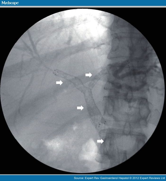 Metal Stents in Malignant Biliary Obstruction - Page 5