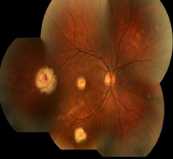 Managing Invasive Candidiasis: A Systematic Approach