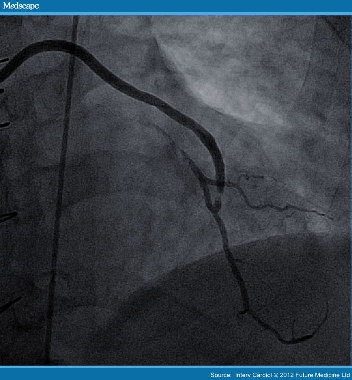 Thrombus Grading for Coronary Interventions - Page 4