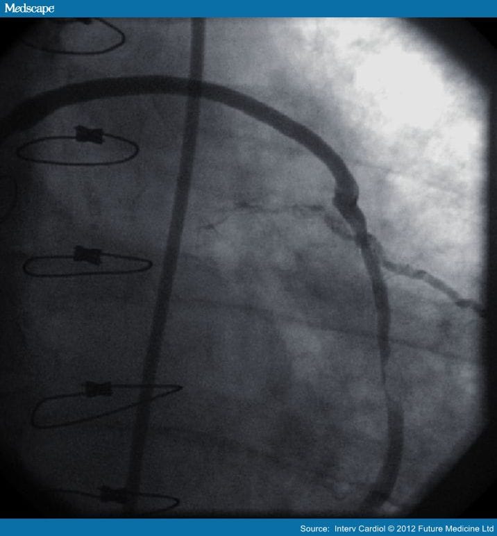 Thrombus Grading for Coronary Interventions - Page 4