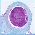 Thrombus Grading for Coronary Interventions - Page 2