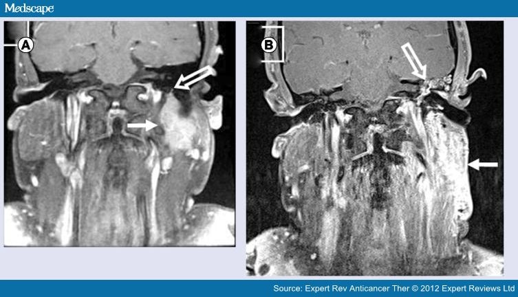 Perineural Invasion and Spread in Head and Neck Cancer - Page 7