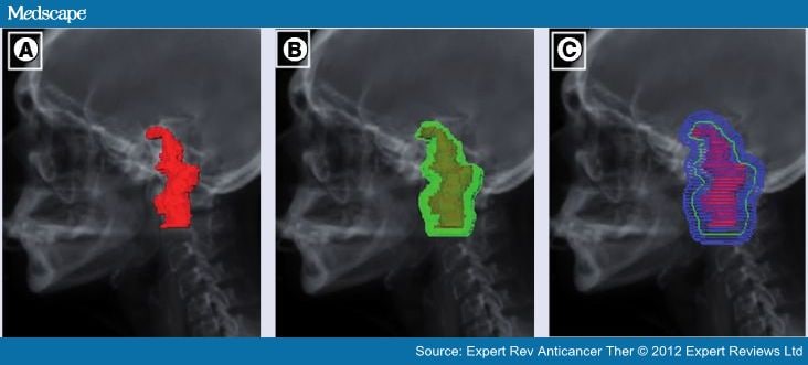 Perineural Invasion and Spread in Head and Neck Cancer - Page 8
