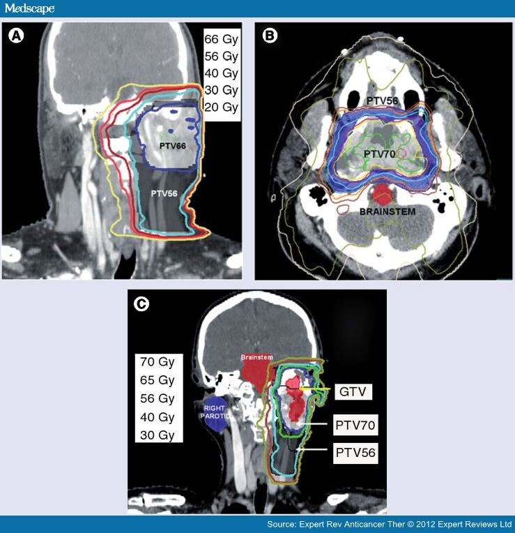 Perineural Invasion and Spread in Head and Neck Cancer - Page 9
