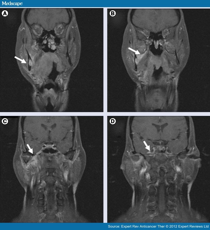 Perineural Invasion and Spread in Head and Neck Cancer - Page 3