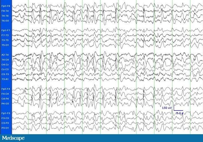 Lennox-Gastaut Syndrome: Case Challenges From Presentation Through ...