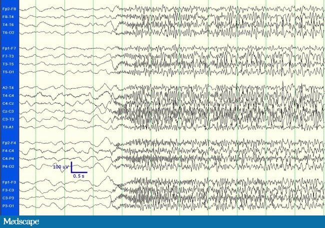 Lennox-Gastaut Syndrome: Case Challenges From Presentation Through ...
