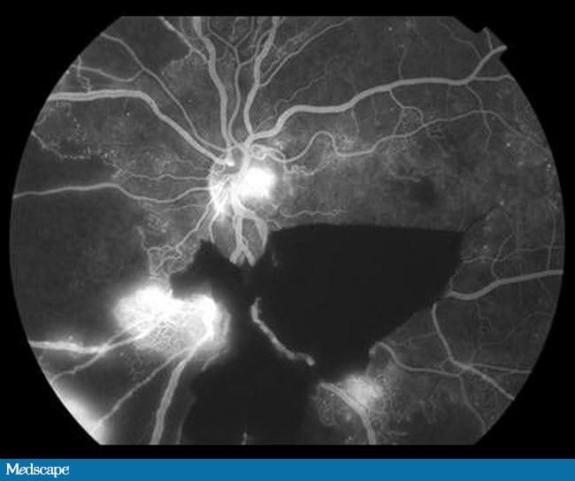 Diabetic Retinopathy: A Team Approach - Page 3