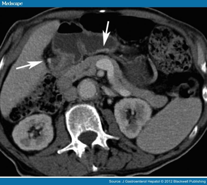 CT Enterography in Patients With Obscure GI Bleeding - Page 3