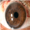 DSAEK: Peripheral Edema Following Displaced Corneal Graft - Page 3