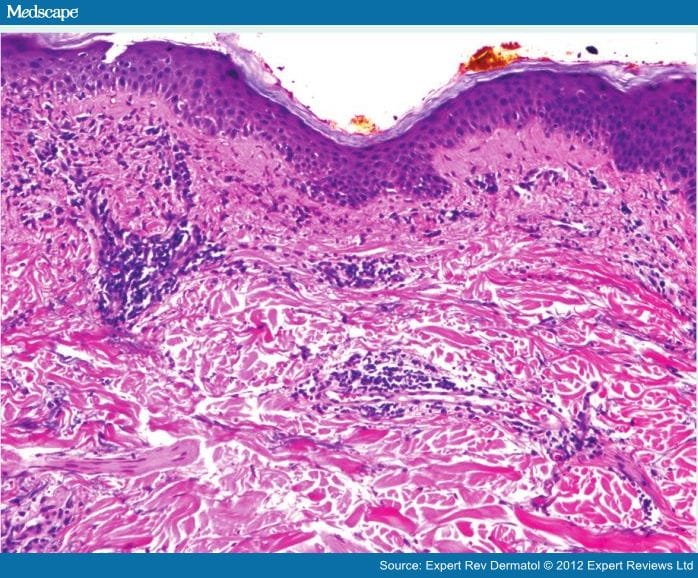 Dermatomyositis Histology
