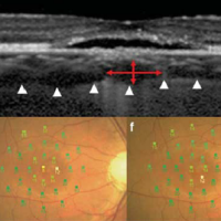 Half-dose versus One-third-dose Photodynamic Therapy for Chronic ...