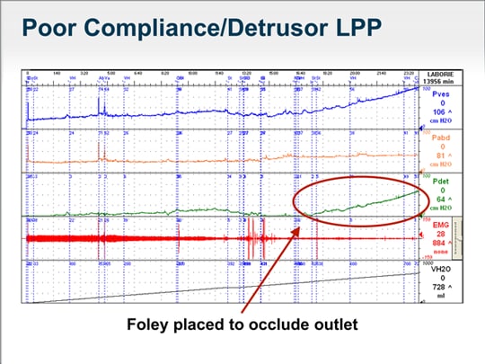 Urodynamic Studies for Neurogenic Bladder: Why, When, and in Whom ...