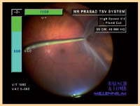 A Review of Endophthalmitis Following Vitrectomy