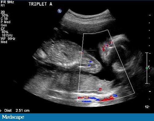 Dangerous Findings in a Multifetal Gestation