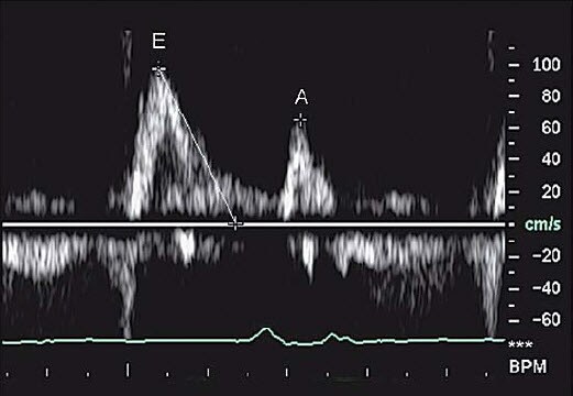 PAH vs PVH: A Tale of 2 Ventricles