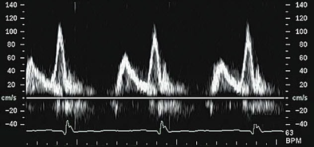 PAH vs PVH: A Tale of 2 Ventricles