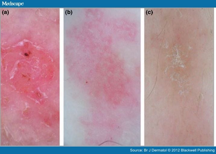 Dermoscopy for Diagnosis of Inflammatory Skin Diseases