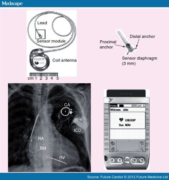 Remote Monitoring in Cardiology and Evidence From Trial Data - Page 7