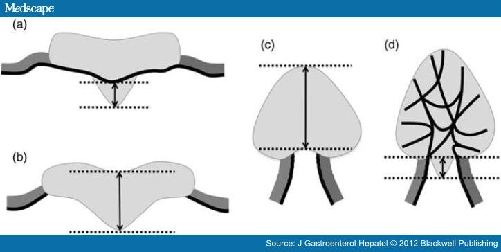 Management of T1 Colorectal Carcinoma - Page 2