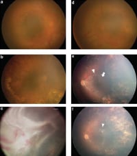 Delayed Atypical Vitreoretinal Traction Band Formation After ...