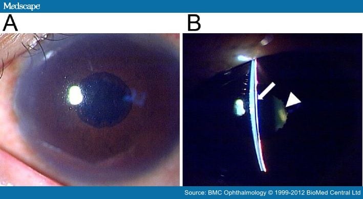 Fibrin Membrane Pupillary-block Glaucoma in Cataract Surgery - Page 3