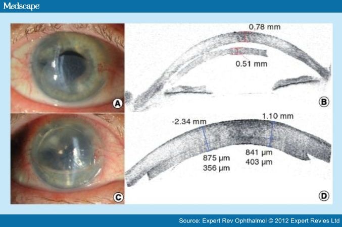 OCT in Cornea and Refractive Surgery - Page 3