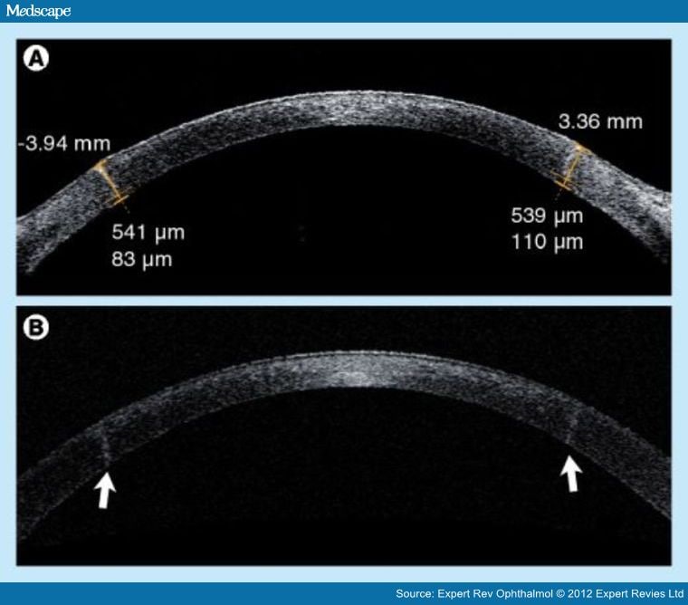 OCT in Cornea and Refractive Surgery - Page 4