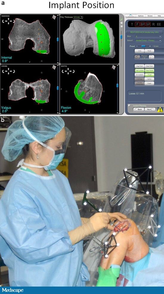 TKA Becomes More Precise With Computers, Robots