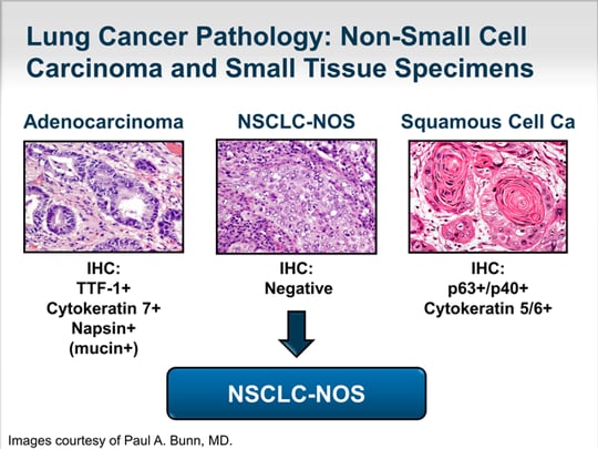 Practical Considerations in the Diagnosis and Treatment of NSCLC ...