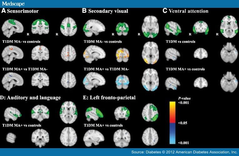 Resting-State Brain Networks in Type 1 Diabetic Patients - Page 3
