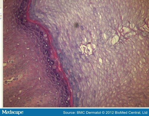 Acral Peeling Skin Syndrome in Two East-African Siblings - Page 3