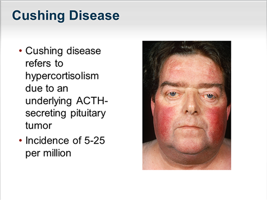 Cushing Disease