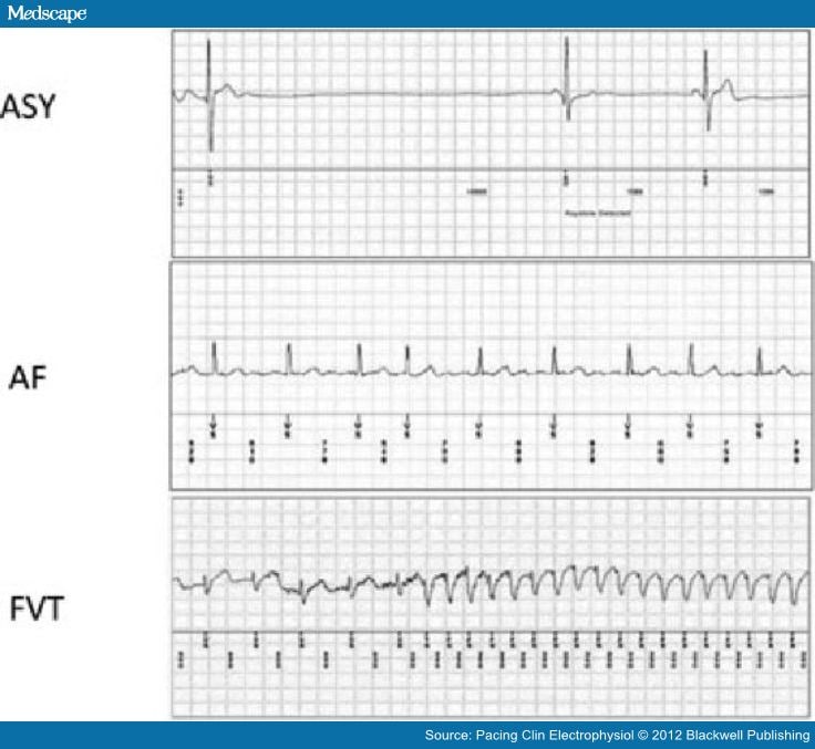 Indications for Implantable Cardiac Monitors