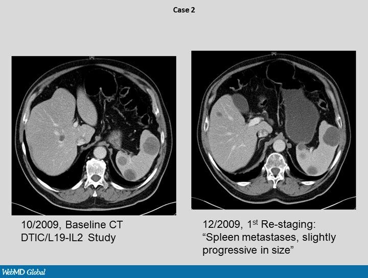 New Treatment Options for Patients with Metastatic Melanoma—Part 2