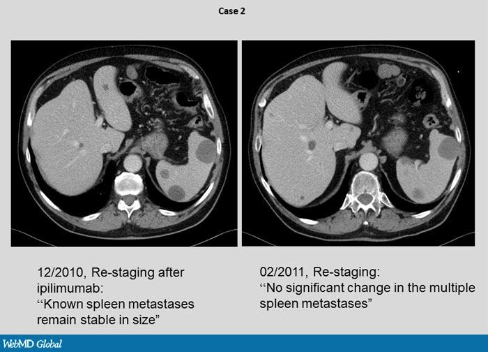 New Treatment Options for Patients with Metastatic Melanoma—Part 2