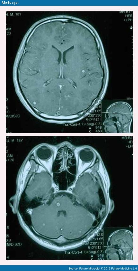 Tuberculous Meningitis in Adults - Page 3
