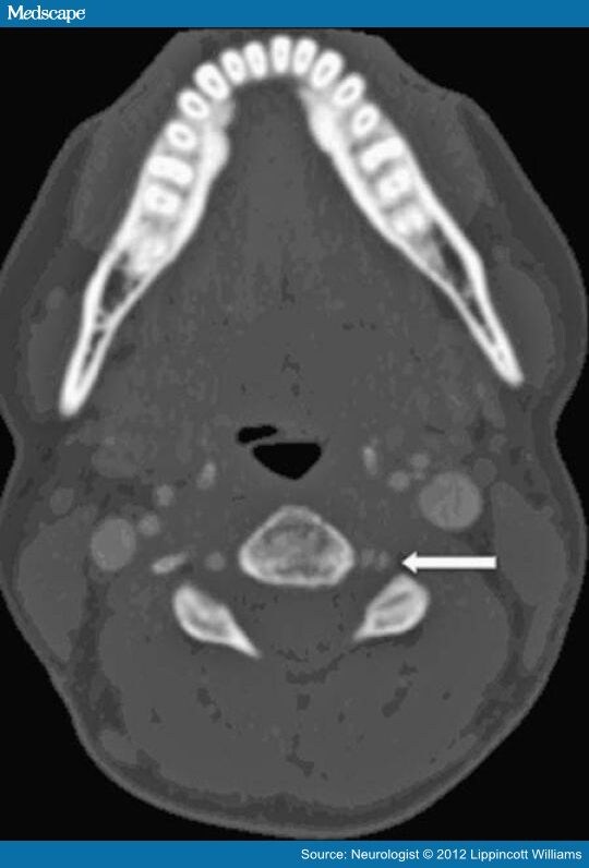 Imaging Characteristics of Vertebral Artery Dissection - Page 2