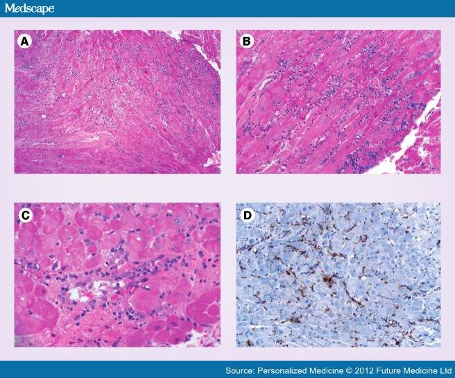 Genetics & Genomics: Detection of Heart Transplant Rejection - Page 2