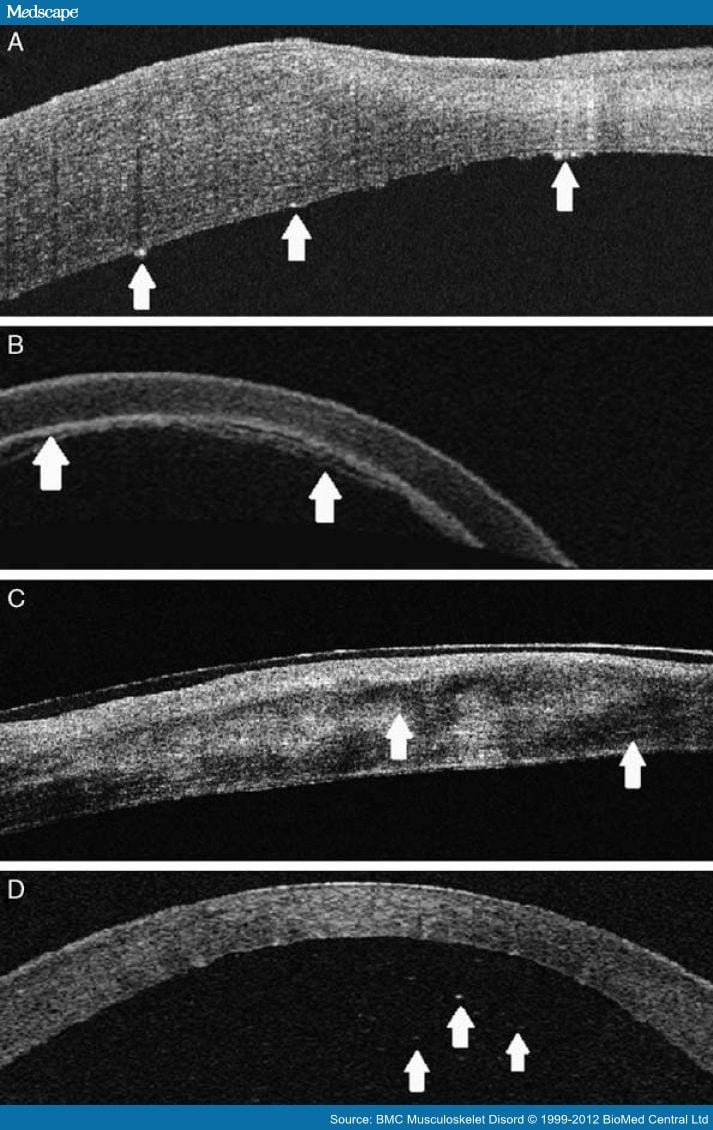 Use of OCT in the Diagnosis and Management of Uveitis - Page 2