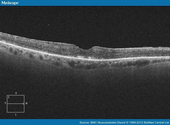 Imaging Methods for Inflammatory Macular Edema - Page 3