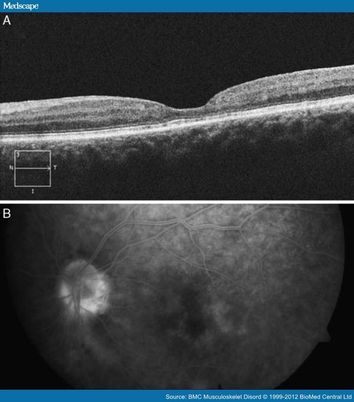 Imaging Methods for Inflammatory Macular Edema - Page 4