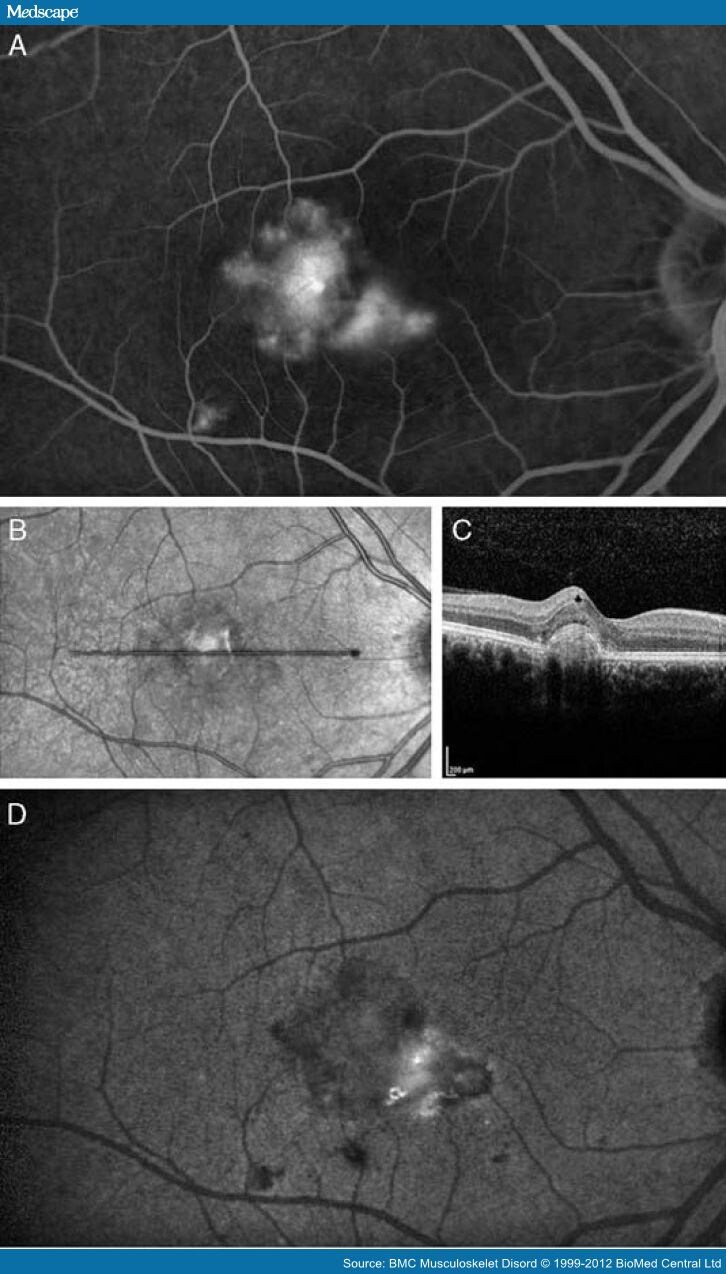 Imaging Methods for Inflammatory Macular Edema - Page 7